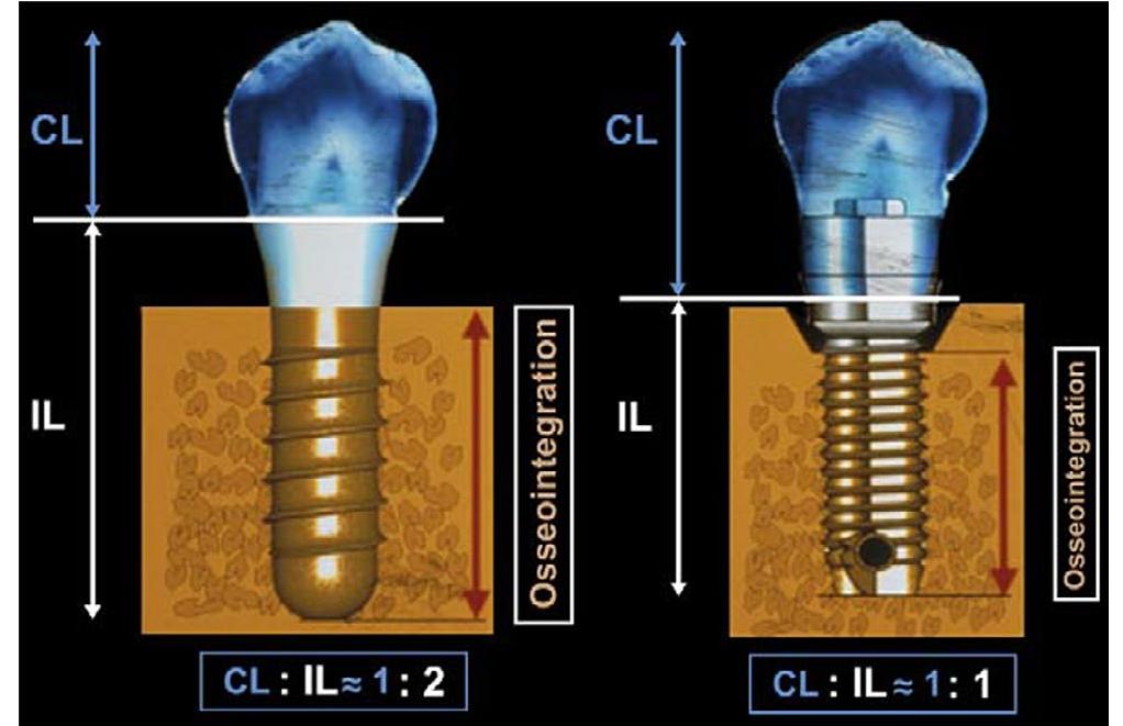 Schematic diagram of a nonsubmerged (one-piece) dental