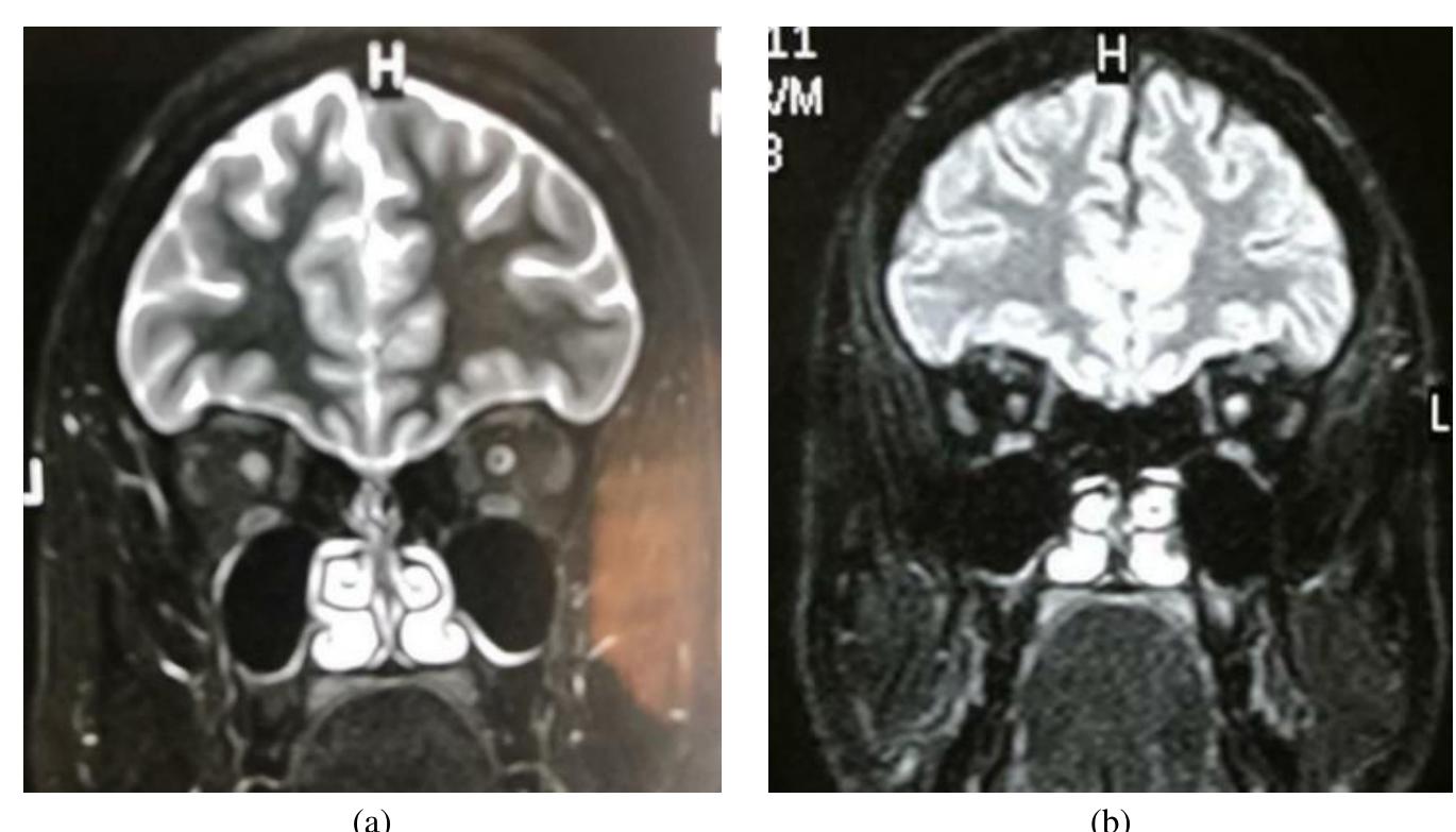 [patient 30- left optic neuritis]: mri t2/flair coronal