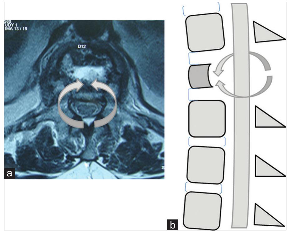 Axial view (a) and sagittal view (b) of transpedicular route