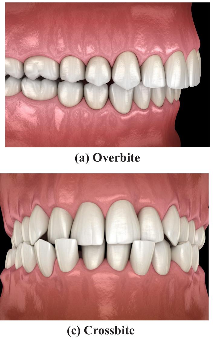 Types of malocclusion different types of malocclusion can