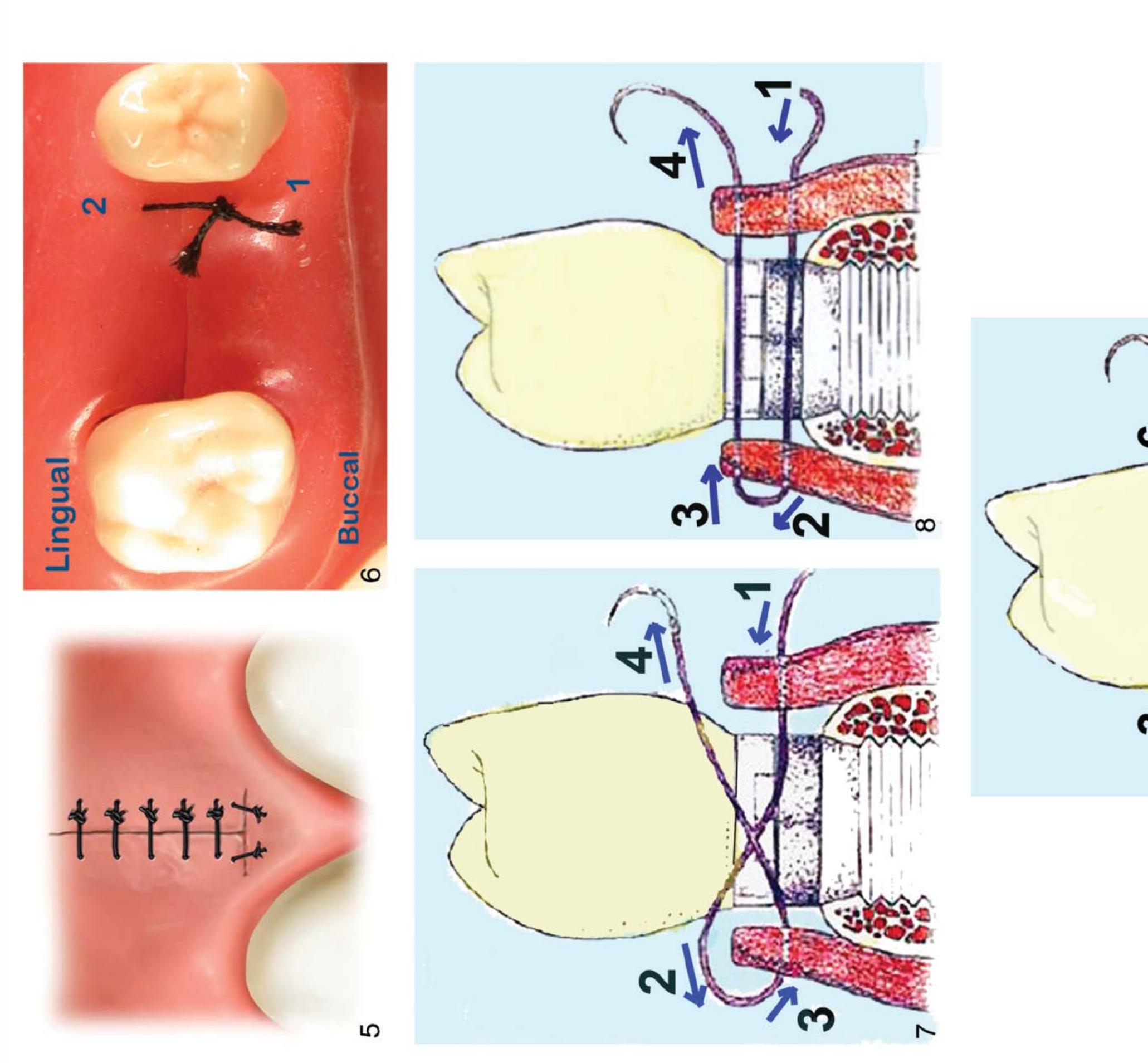 Figure 4 - Suturing for Optimal Soft-Tissue Management