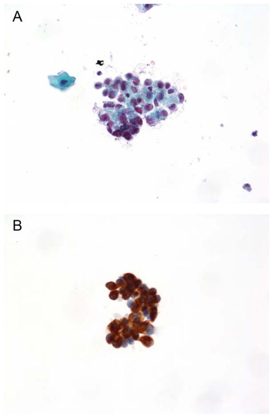 Atypical cells (a) in voided urine (papanicolaou stain,