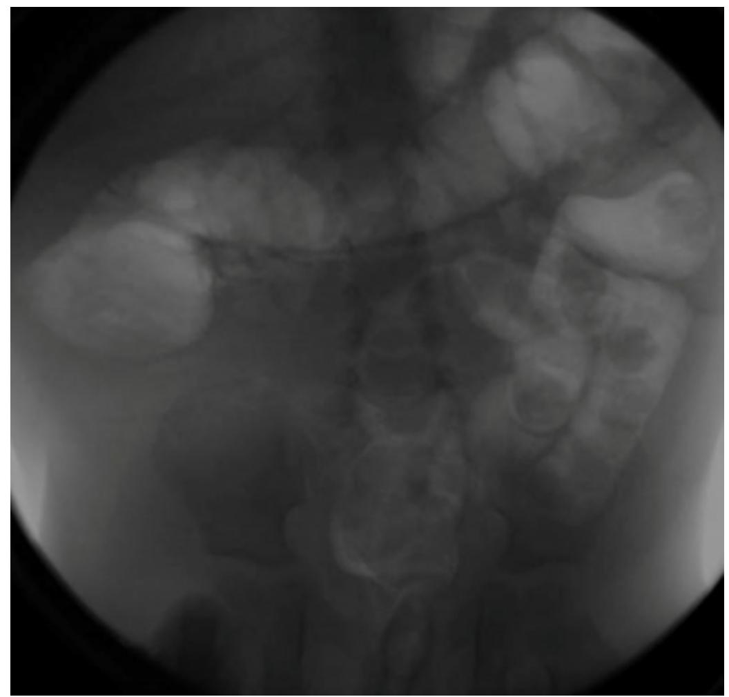 Air enema with intussusception near the hepatic flexure.