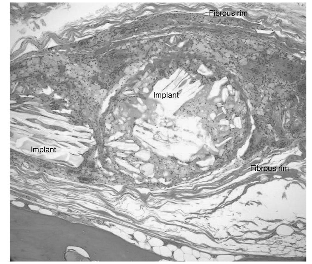 Focally extensive macrophages and giant cells around