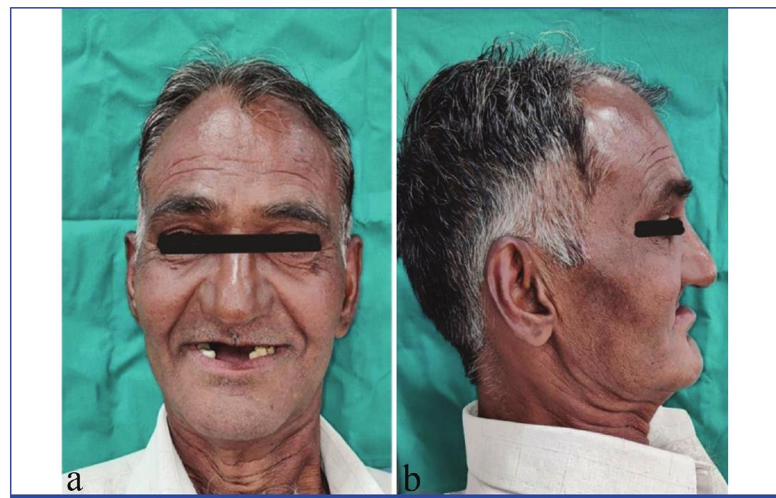 [table/fig-1]: extraoral photographs: a) frontal view; b)