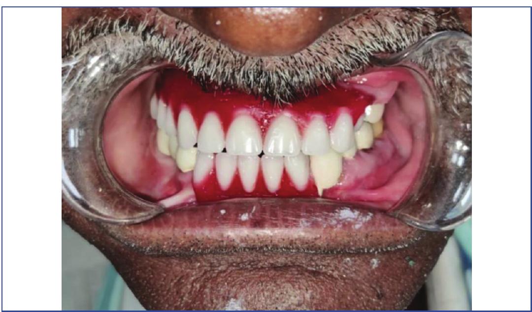 [table/fig-11]: try-in of maxillary and mandibular