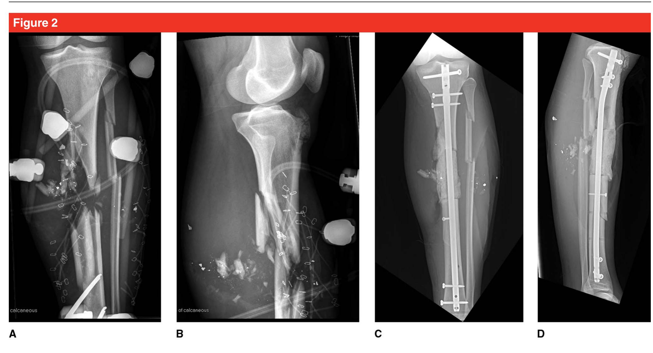 Initial ap (a) and lateral (b) radiographs of the tibia