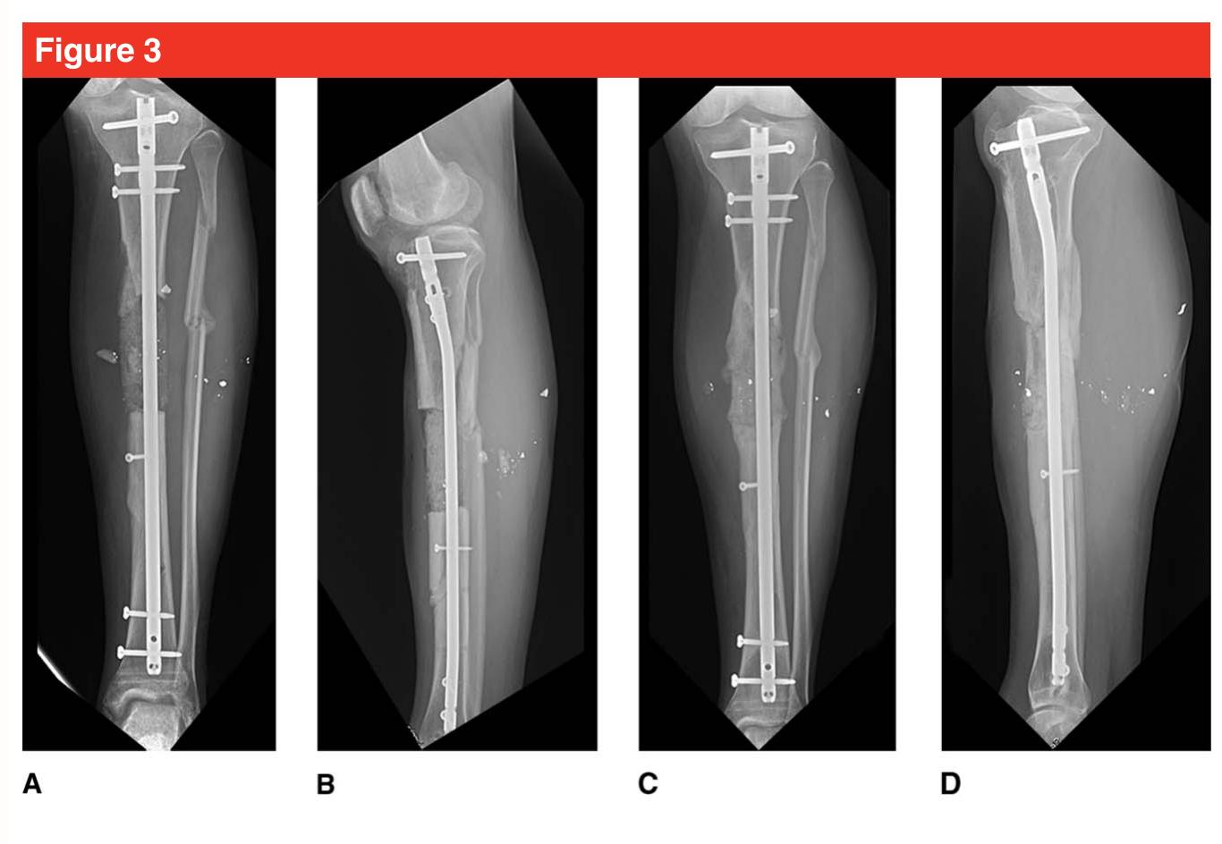 Ap (a) and lateral (b) radiographs of the tibia in the
