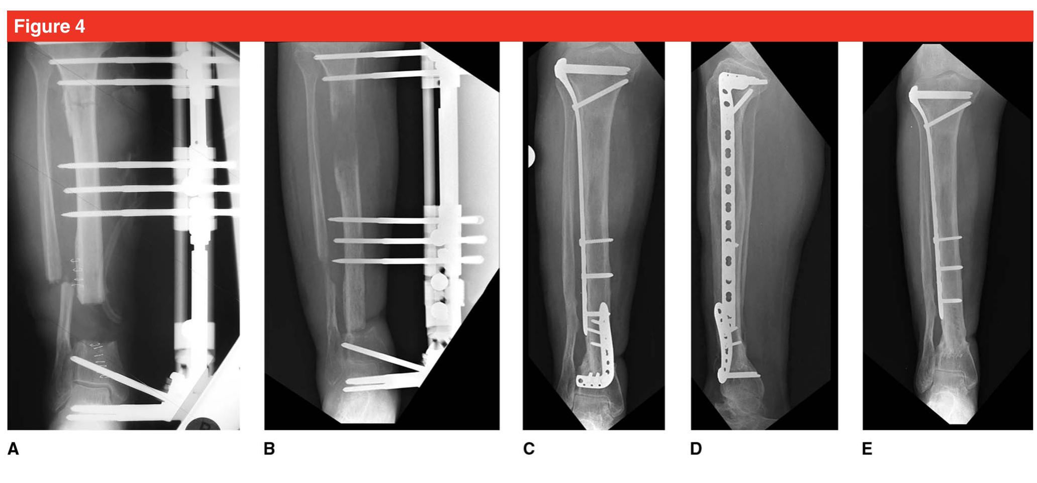 A, ap radiograph of the distal tibia demonstrating a 4-cm