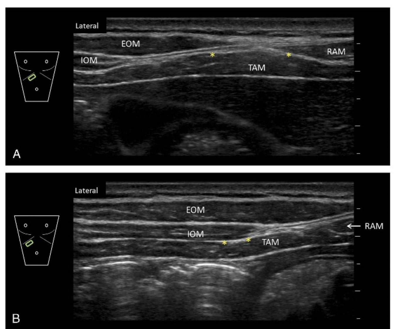 Sonoanatomy of the us-guided subcostal tap block. the probe