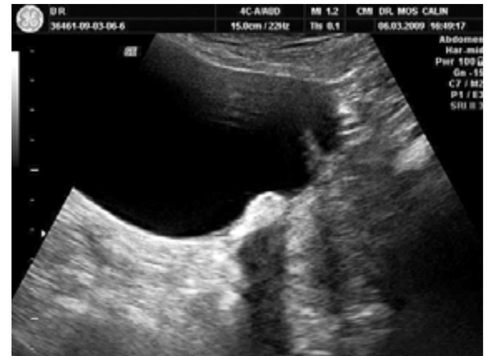 Calcified parietal nodule with acoustic shadowing deter-