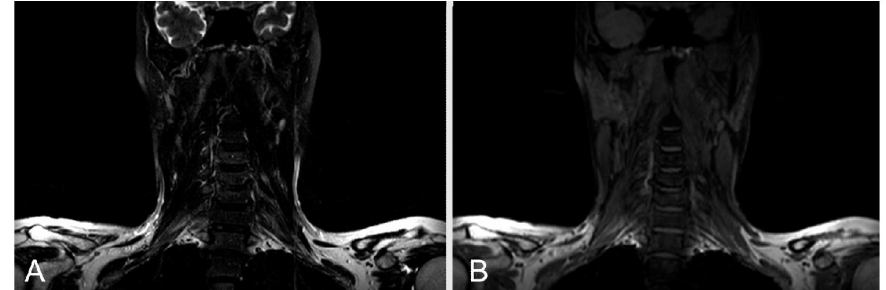 brachial plexitis (a — coronal t2 fs sequence and b —