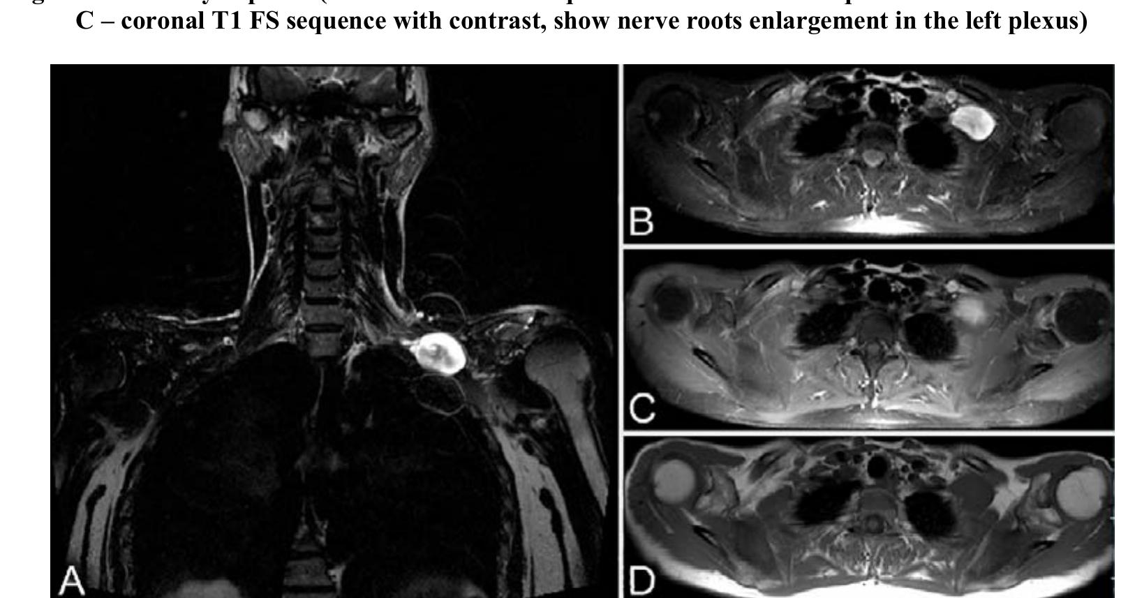 schwannoma in the left supraclavicular fossa (a — coronal