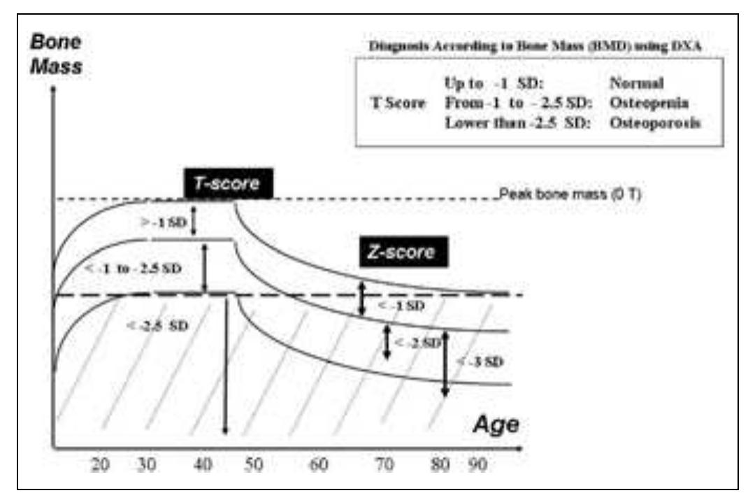 - the who osteoporosis diagnostic criteria: t-score values