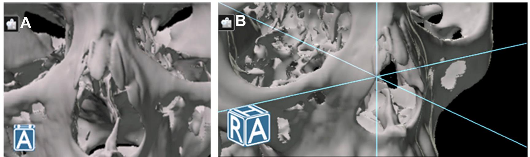 Navigation-guide rhinoplasty: complex nasal fracture with