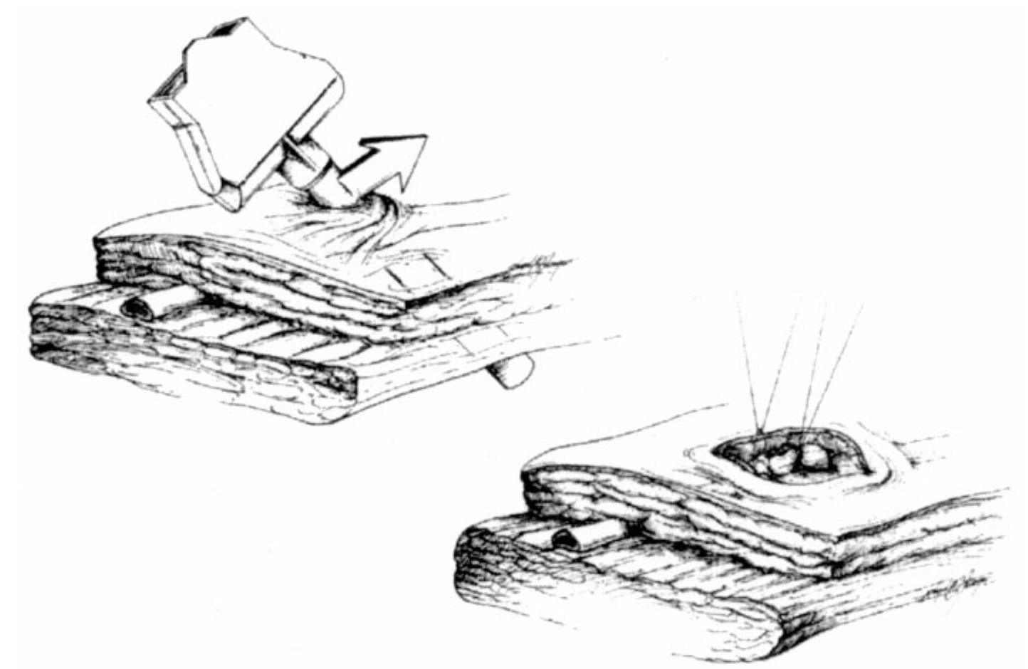 The trocar itself maybe used to tamponade bleeding from an