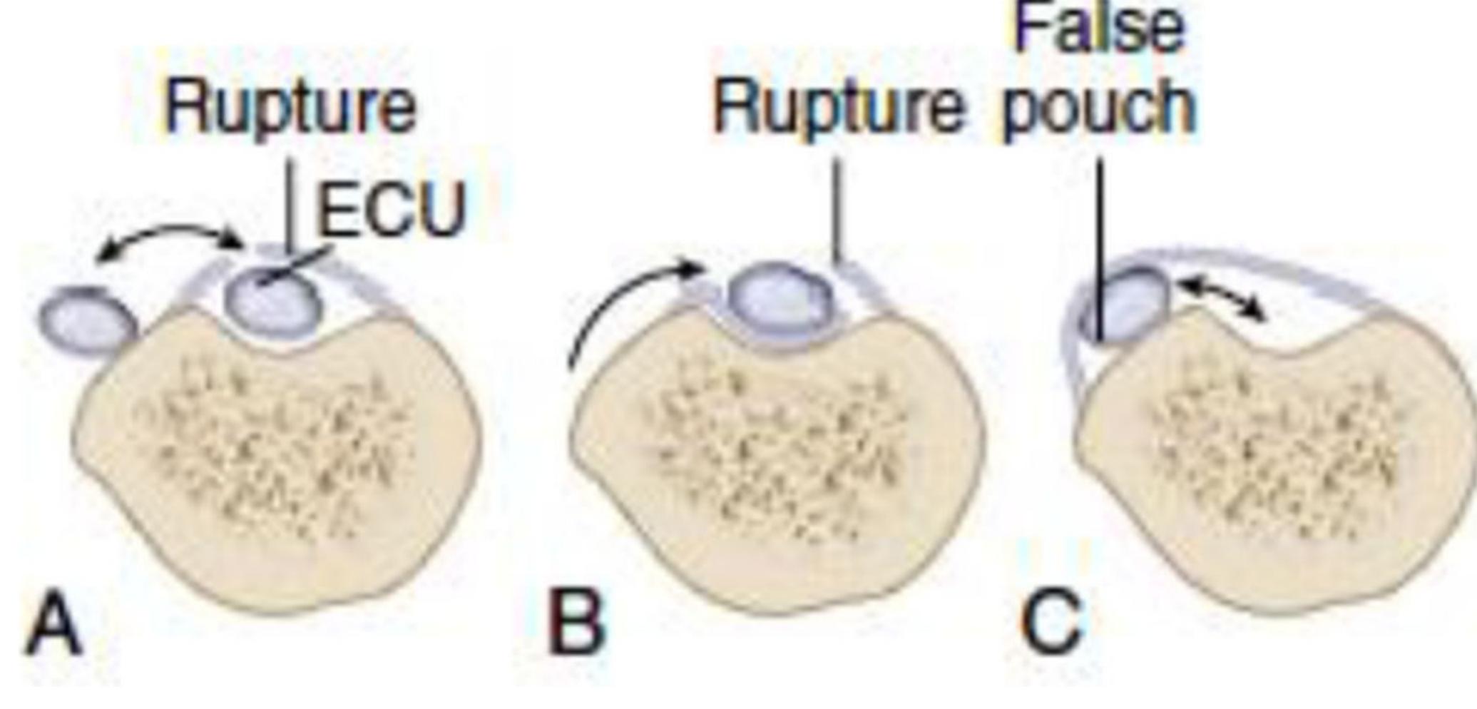 Figure 2 Extensor Carpi Ulnaris Subluxation