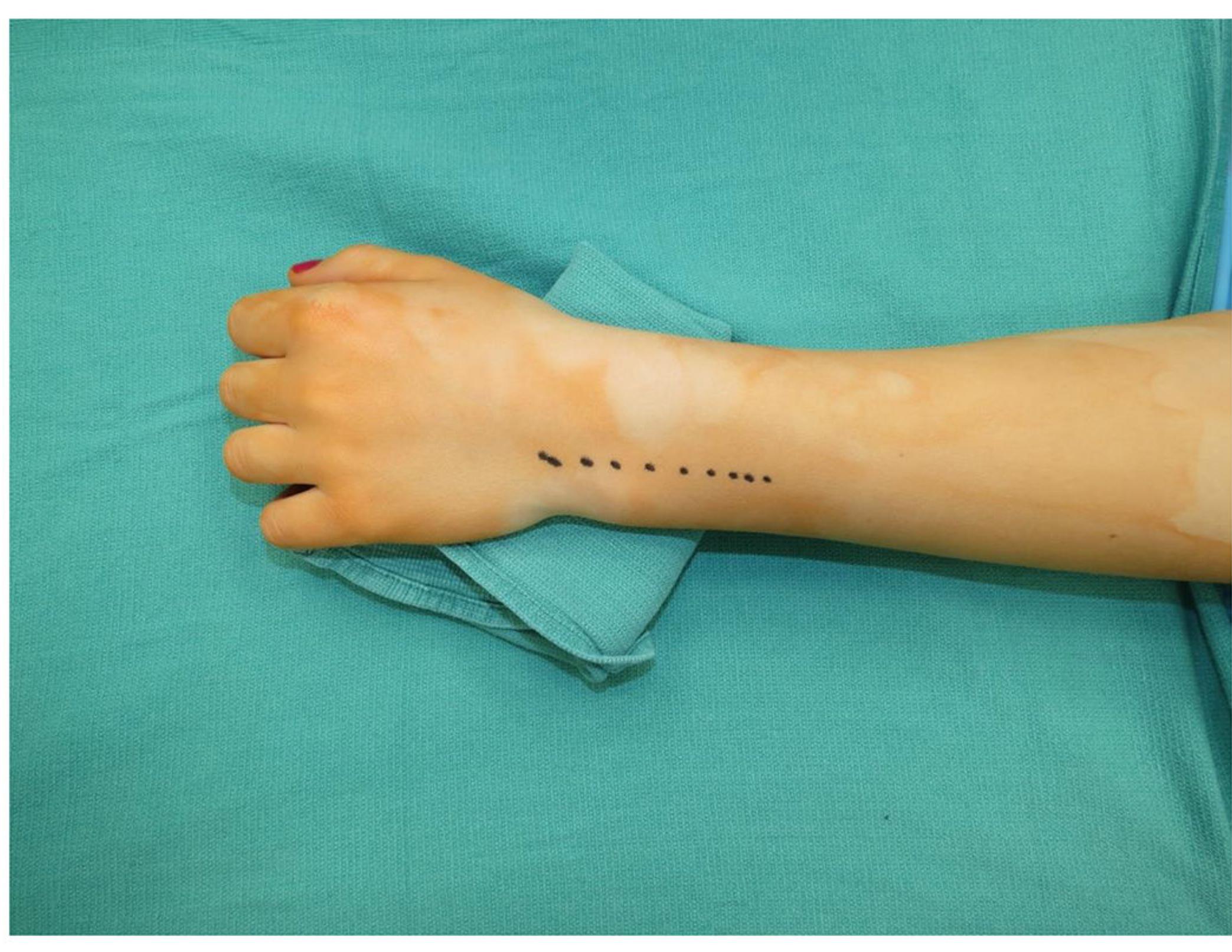 Figure 4 - Extensor Carpi Ulnaris Subluxation