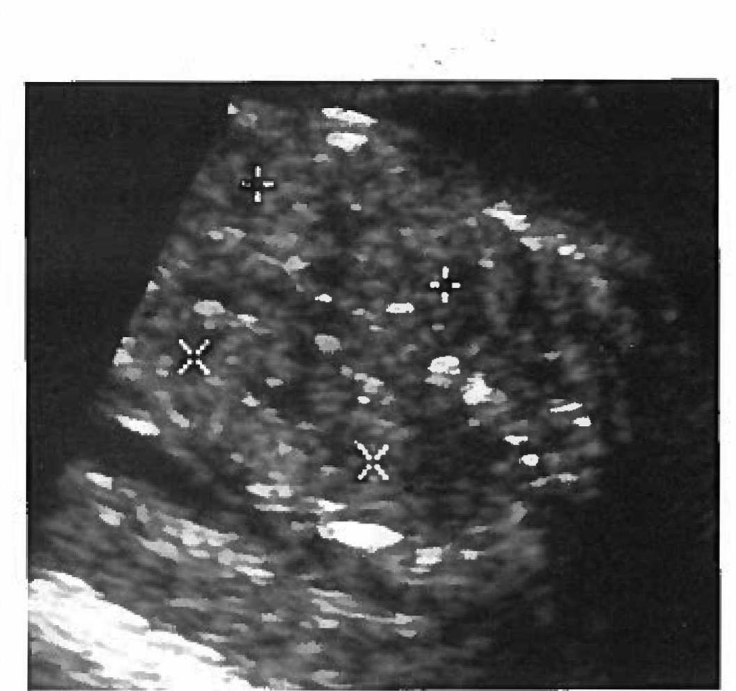 Coronal image through fetal kidneys at 16 weeks of