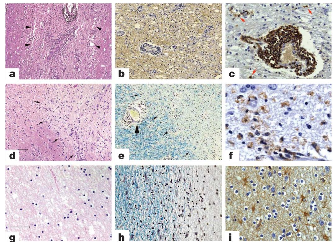 | histopathology of ms brain lesions. staining: a, d, g,