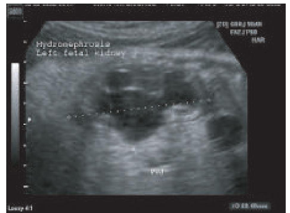 -1: left sided fetal hydronephrosis. he undergoes a left