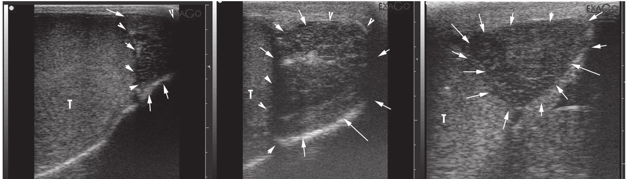 Normal ultrasonogram of the tail of the epididymis (arrows
