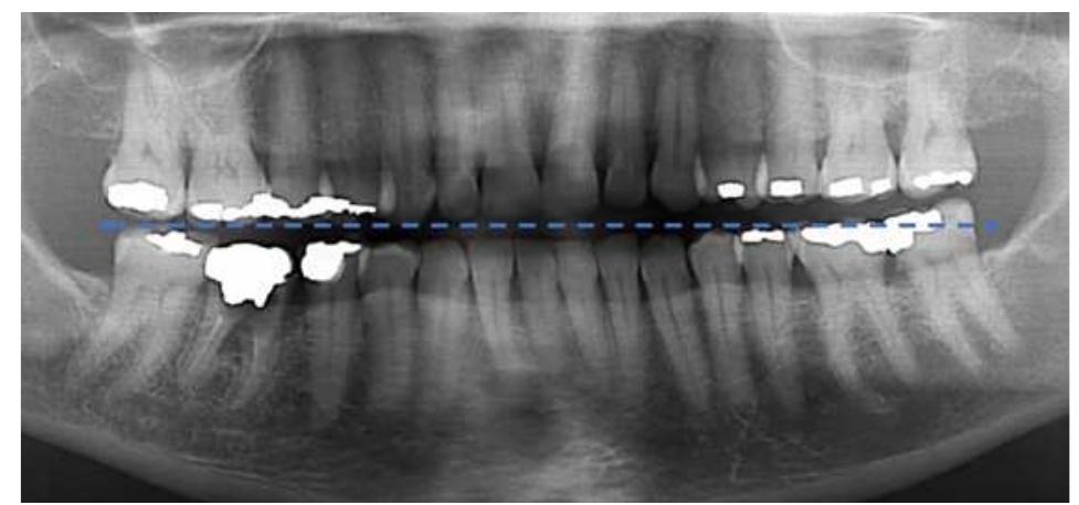 There is an apical radiolucent image, which may mean repair.