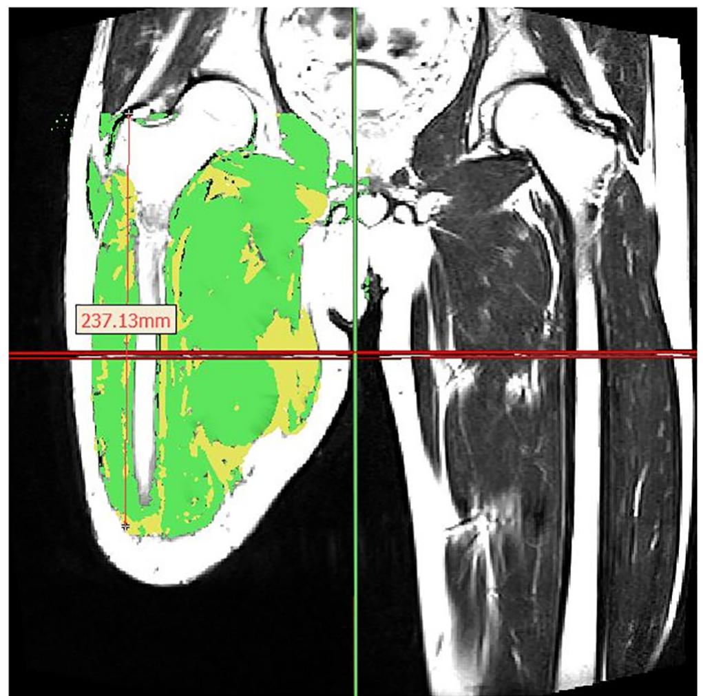 Figure 2 - Myodesis or myoplasty in trans-femoral
