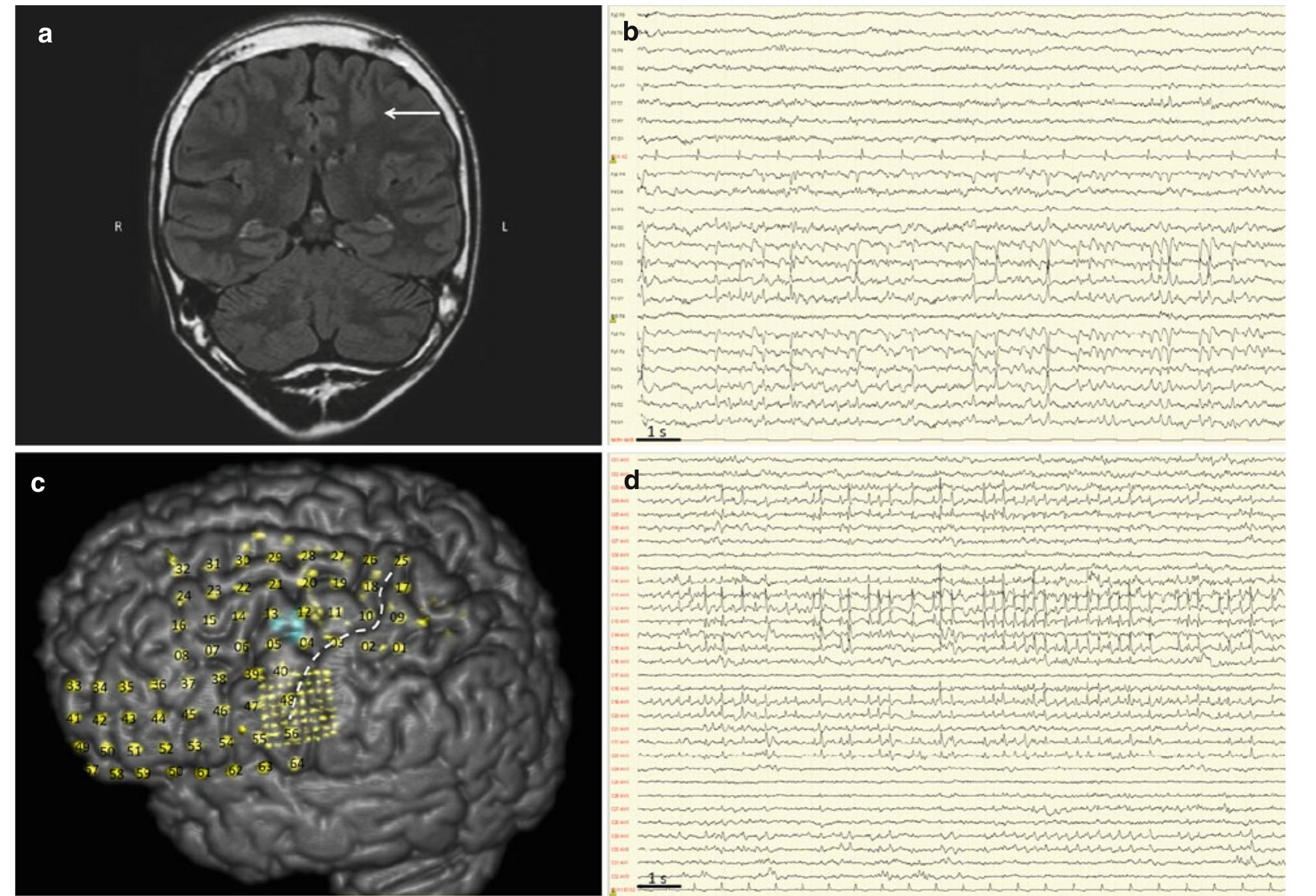 73 focal cortical dysplasia, type ib: (a) coronal mri (3 t,