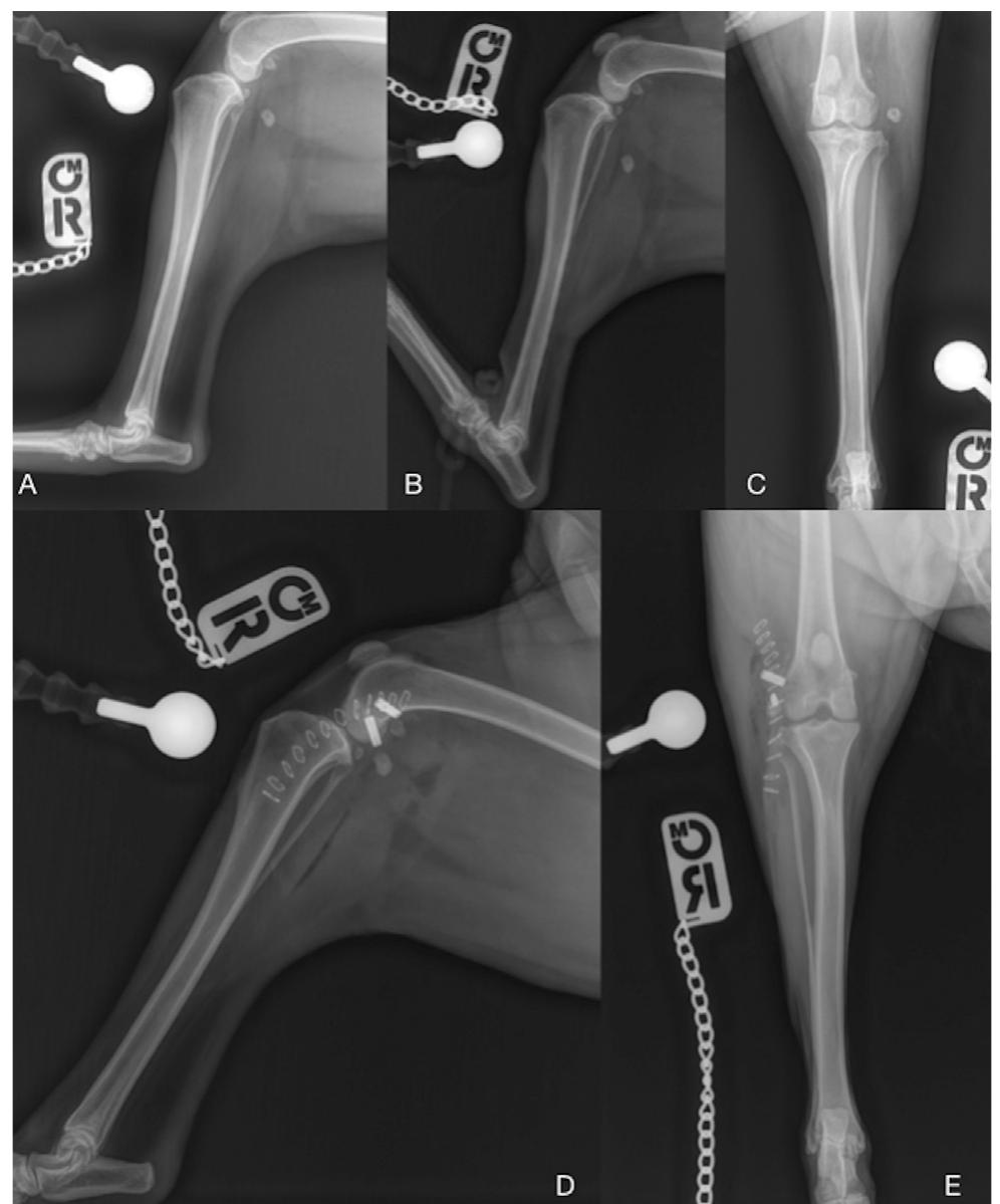 Figure 1 - Avulsion of the Lateral Head of the Gastrocnemius