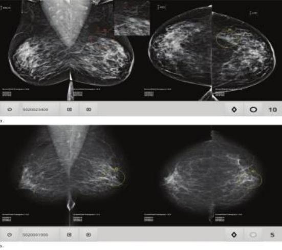 (a) mammograms in 71-year-old woman with invasive ductal