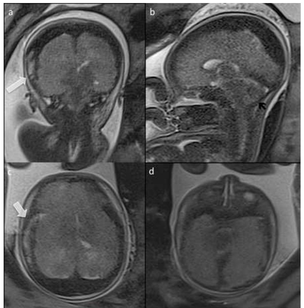 fetal mri. 35-week-old fetus. coronal (a), sagittal (b)
