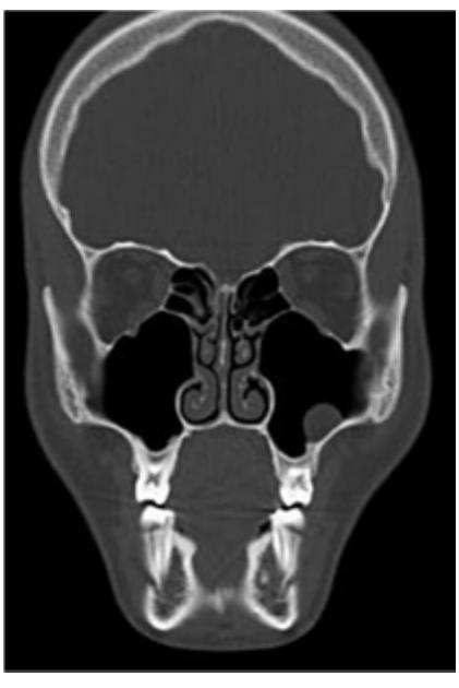 Ct scan image of maxilla. the finite element model of the