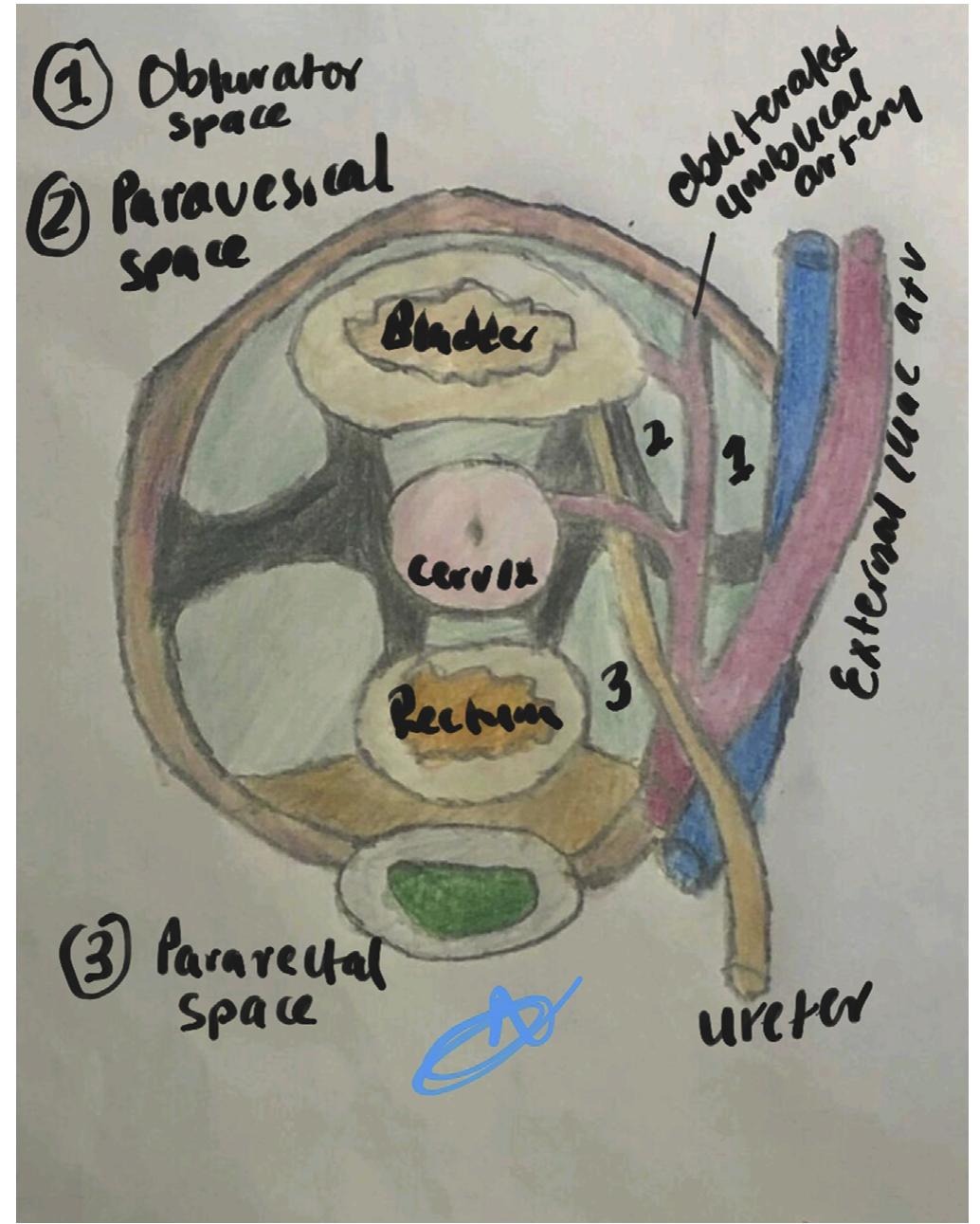 Avascular spaces in laparoscopic sacrocolpopexy is that they