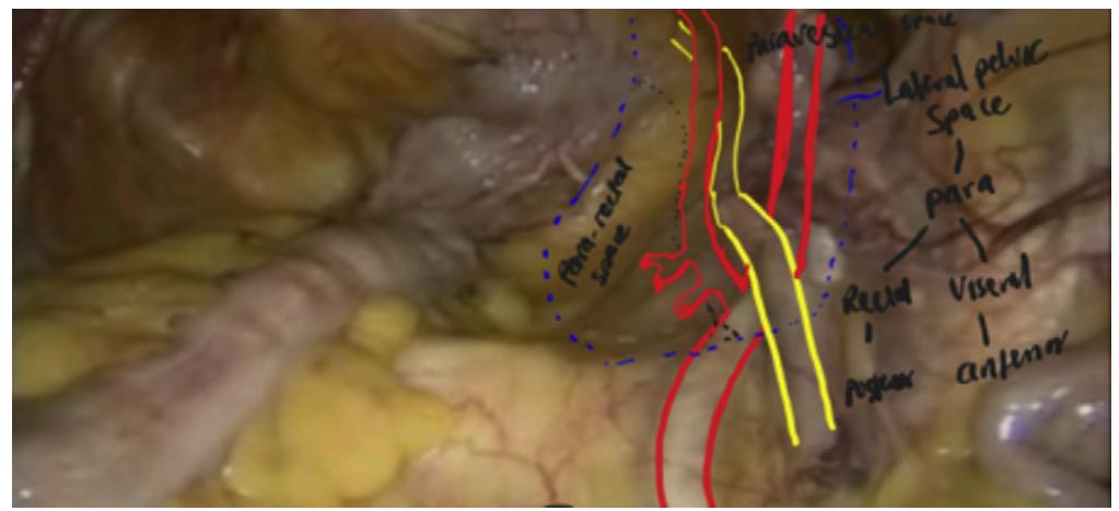 Laparoscopic view of pararectal and paravesical space. see