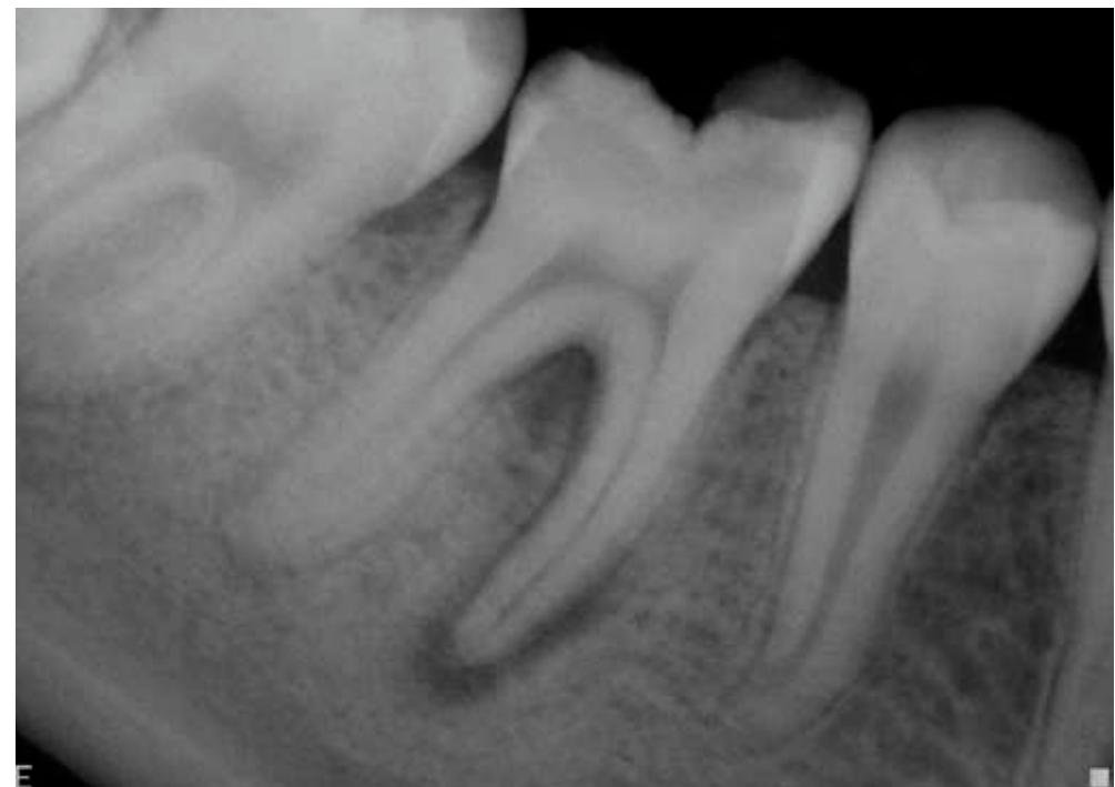 Figure 5 - Revisit to endo-perio lesion a review