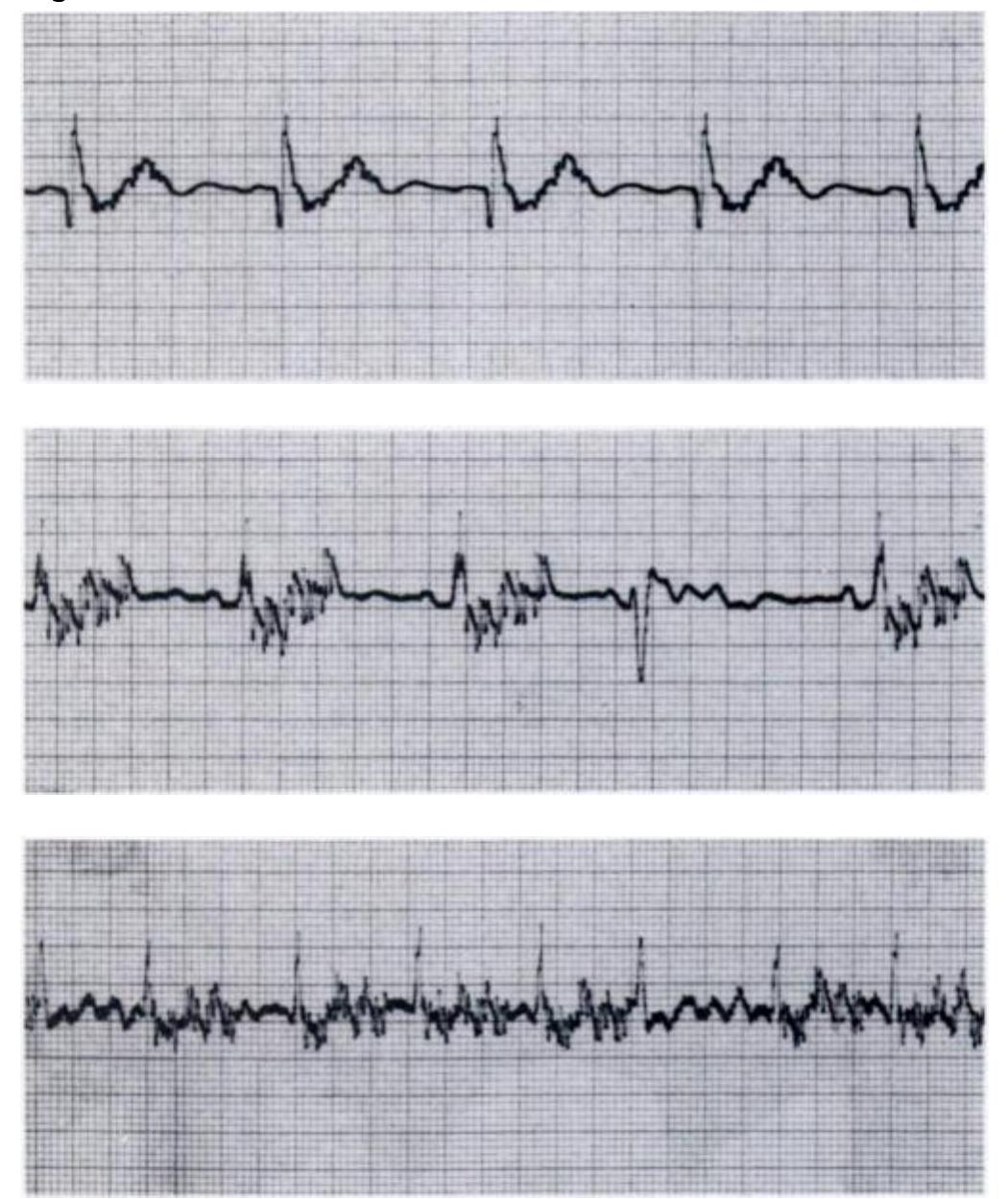 Examples of ecg tracings acquired during mr imaging show (a)