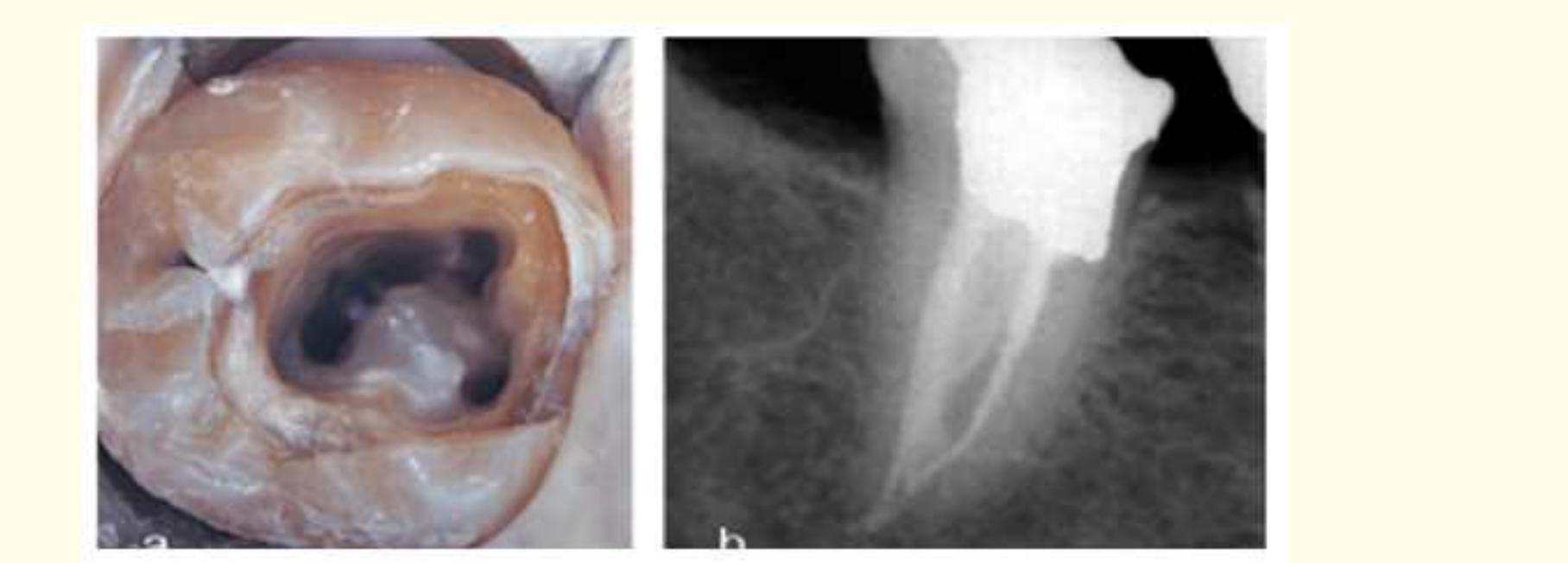 Access cavity of a c shaped molar followed by obturation