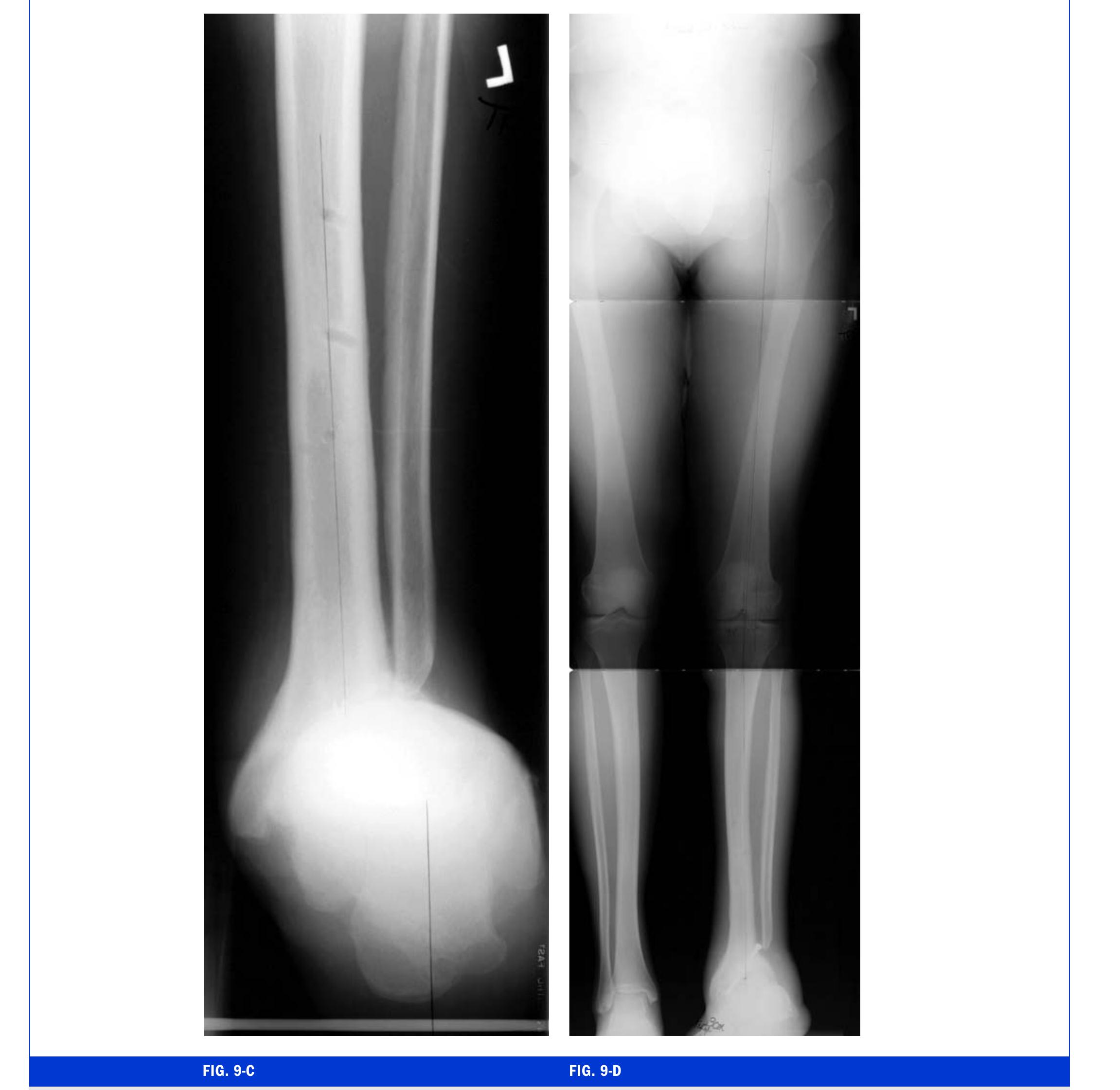 -c saltzman radiograph showing the lateral translation of