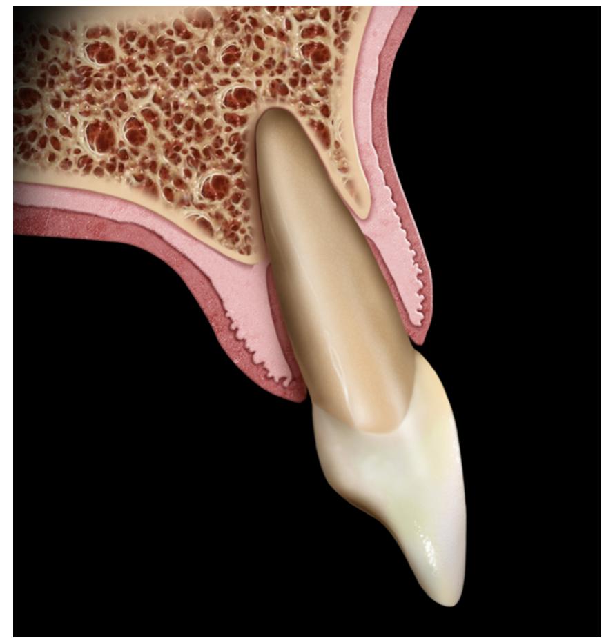 Type 3 classification. in this anatomical situation, a