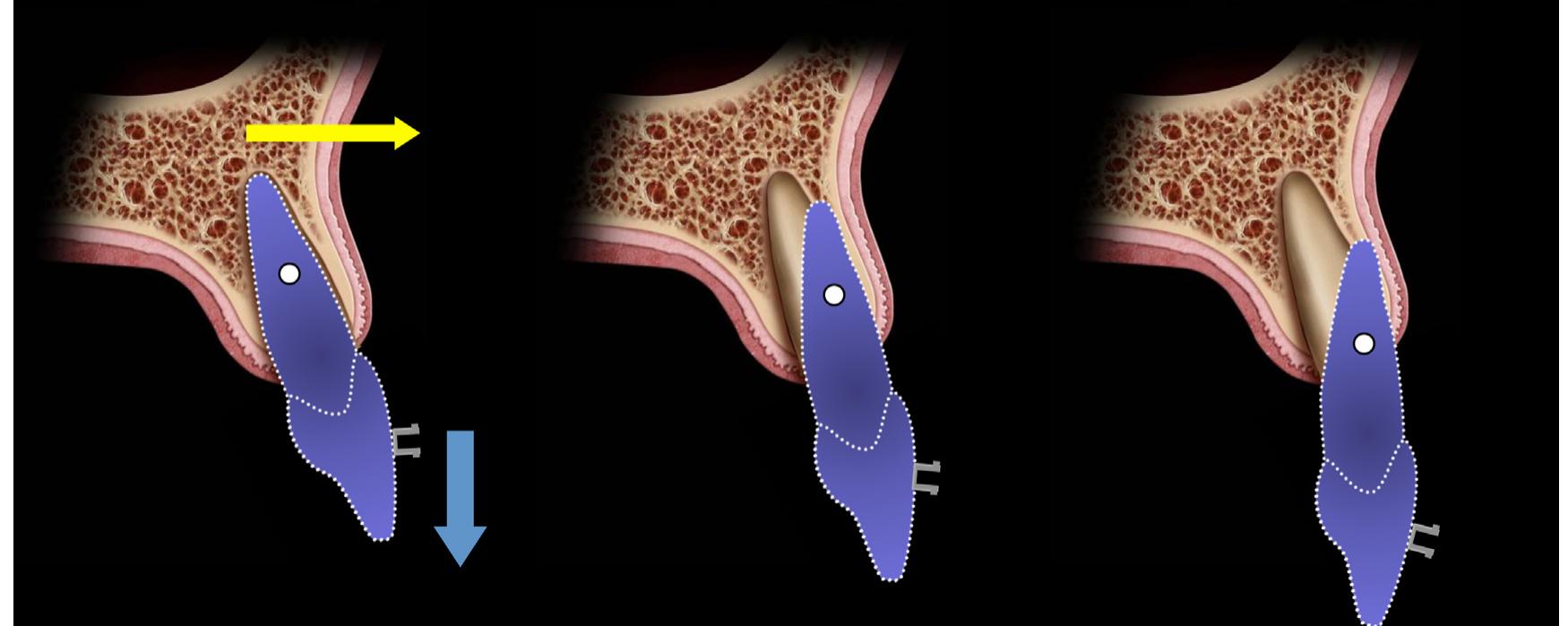 The series illustrates an anterior maxillary tooth with a