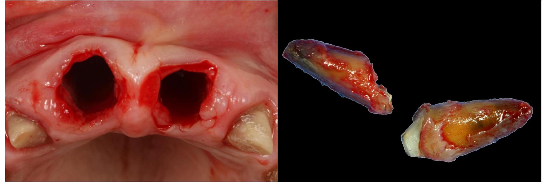 A clinical example of orthodontic extrusion using a