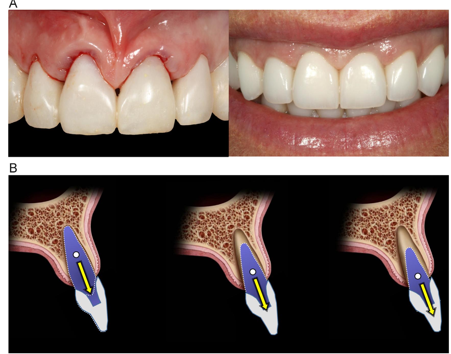 A clinical example of orthodontic extrusion using a