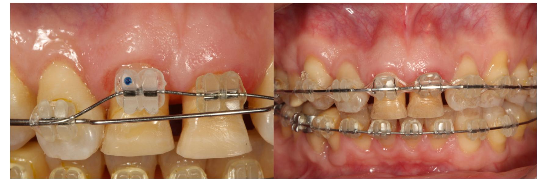 Orthodontic extrusion of teeth numbers 8 and 9 with a base