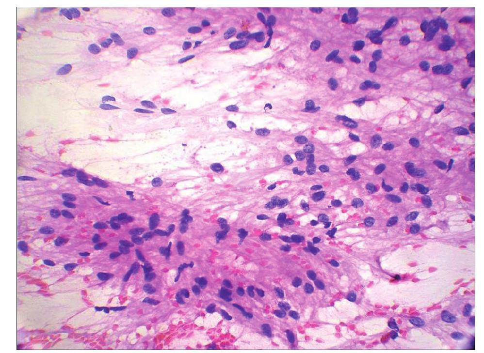 Papanicolaou-stained smear shows spindle cells showing