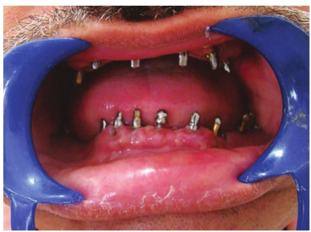 Basal implants placed in maxillary and mandibular arch