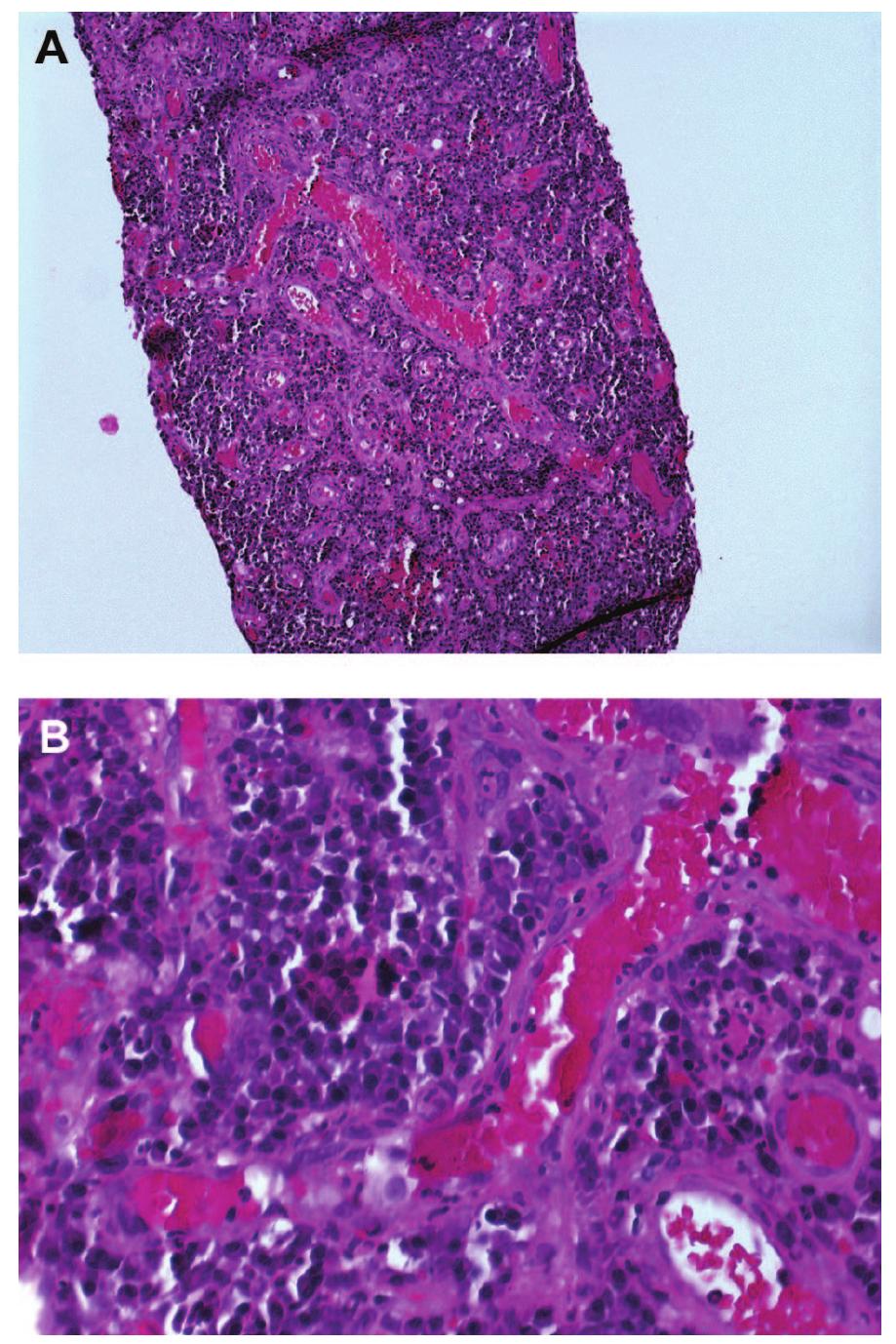 A, canalicular pyogenic granuloma (hematoxylin and eosin