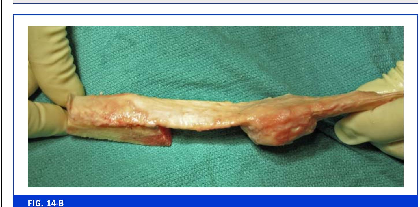 Figure 15 - Extensor Mechanism Allograft Reconstruction