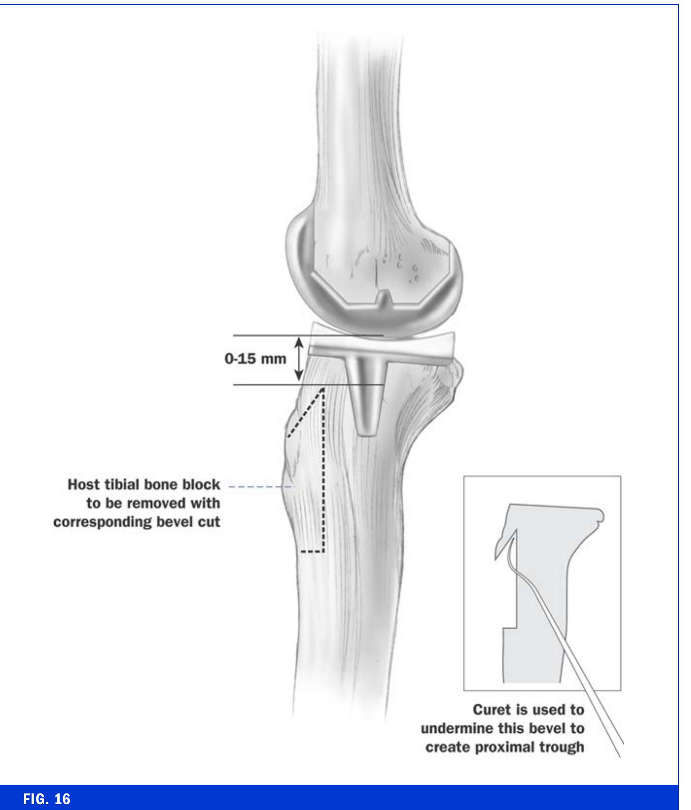 The proximal host tibial trough is also beveled under to