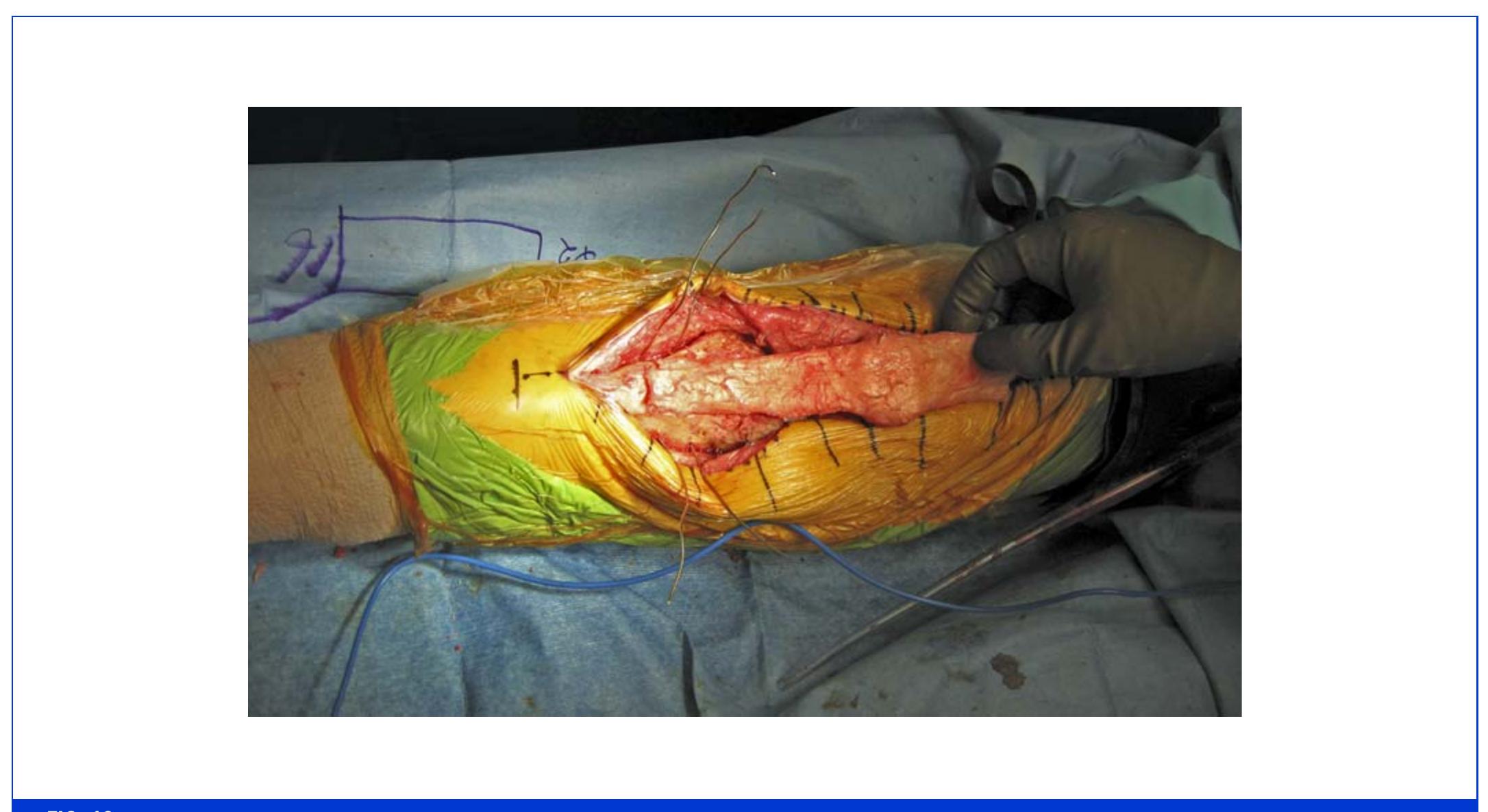 Fixation of the tibial allograft with stainless steel wires,